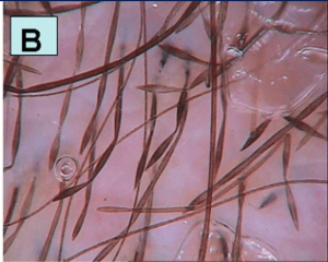 모발 기형 질환과 비정상 머리카락 종류 - GRITYOGURT